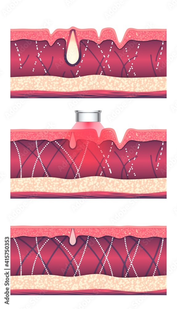 Laser skin rejuvenation. Acne treating, wrinkle removal, and collagen ...