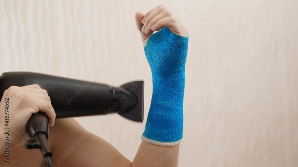 Broken wrist in fiberglass plaster cast. Male hand wrapped in a modern ...