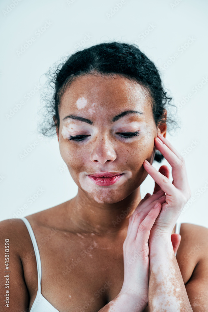 Beautiful woman with vitiligo skin posing in studio. Concept about body ...