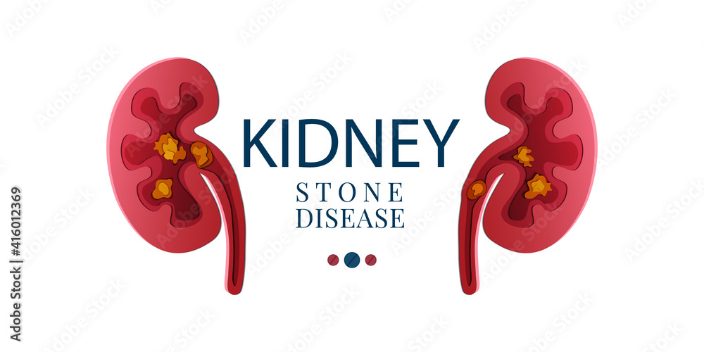 Kidney stone disease awareness poster with kidneys made in 3D paper cut ...