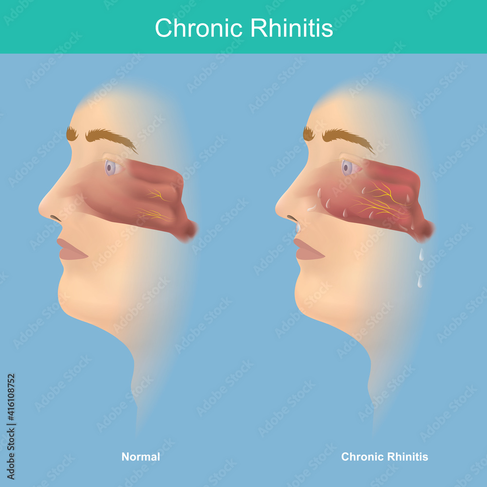 Vecteur Stock Chronic Rhinitis. This illustration medical use for ...
