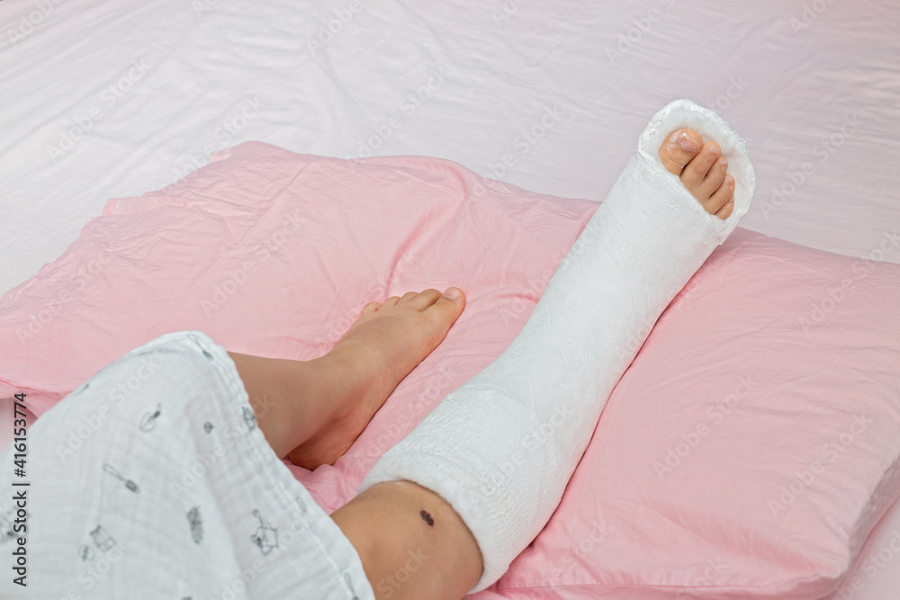 Bone fractures on the leg of a child. Children's leg in a cast on the ...