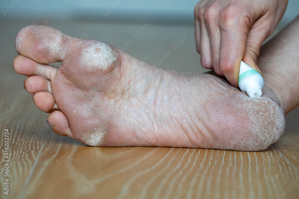 Image for medical purposes. Dry skin, plantar callosity and flakes on ...
