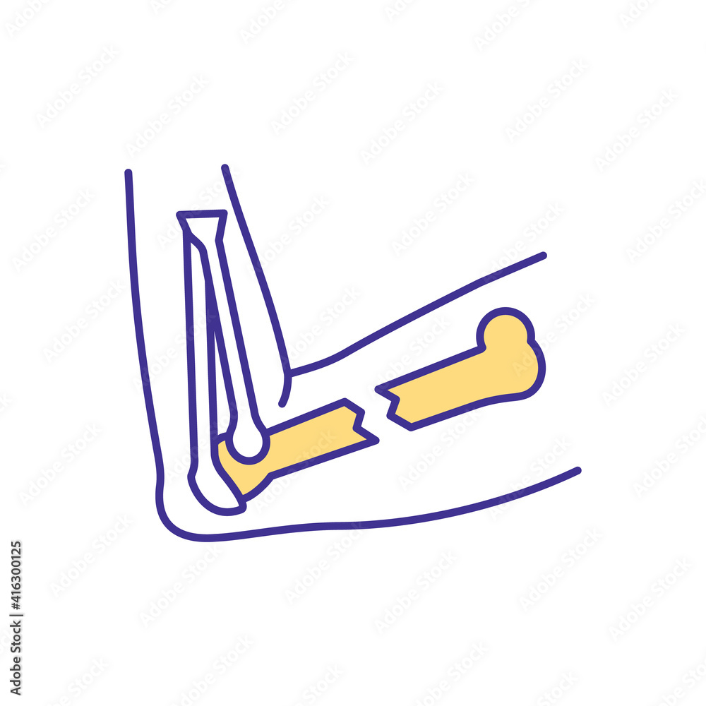 Elbow fracture RGB color icon. Visible arm deformity. Broken bones ...