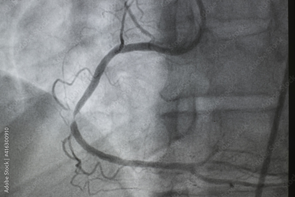 Coronary angiogram , medical x-ray for heart disease. Coronary artery ...