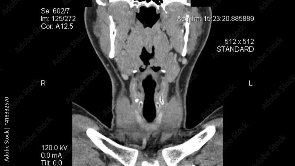 Front Coronal plane tomography: CT scan layers of lower face and neck ...