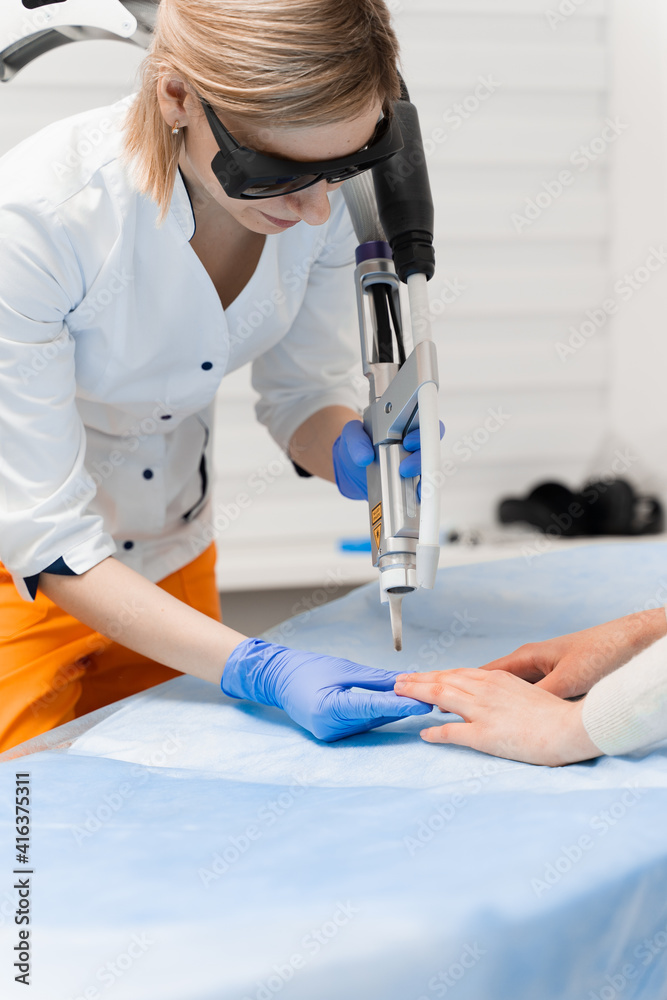 Laser treatment of onychomycosis. fungal infection on the hands of a ...