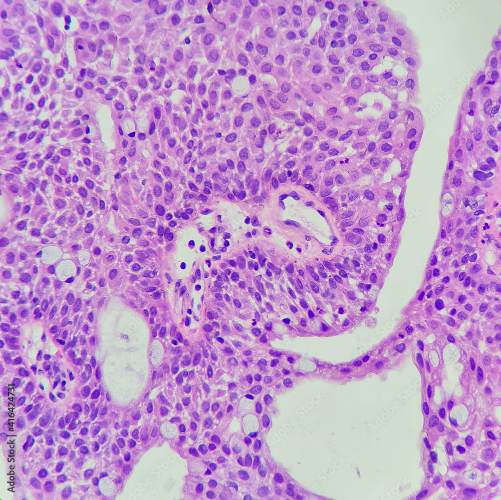 Photo of conjunctival papilloma, showing squamous epithelium with ...