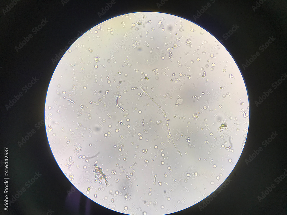 Fungus infection show budding yeast cells and pheudohyphae in urine ...