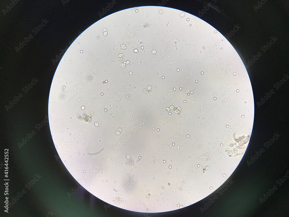 Fungus infection show budding yeast cells and pheudohyphae in urine ...