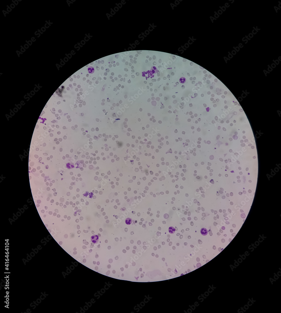 Microscopic view of hematology slide. RBC. WBC. closeup. Stained slide ...