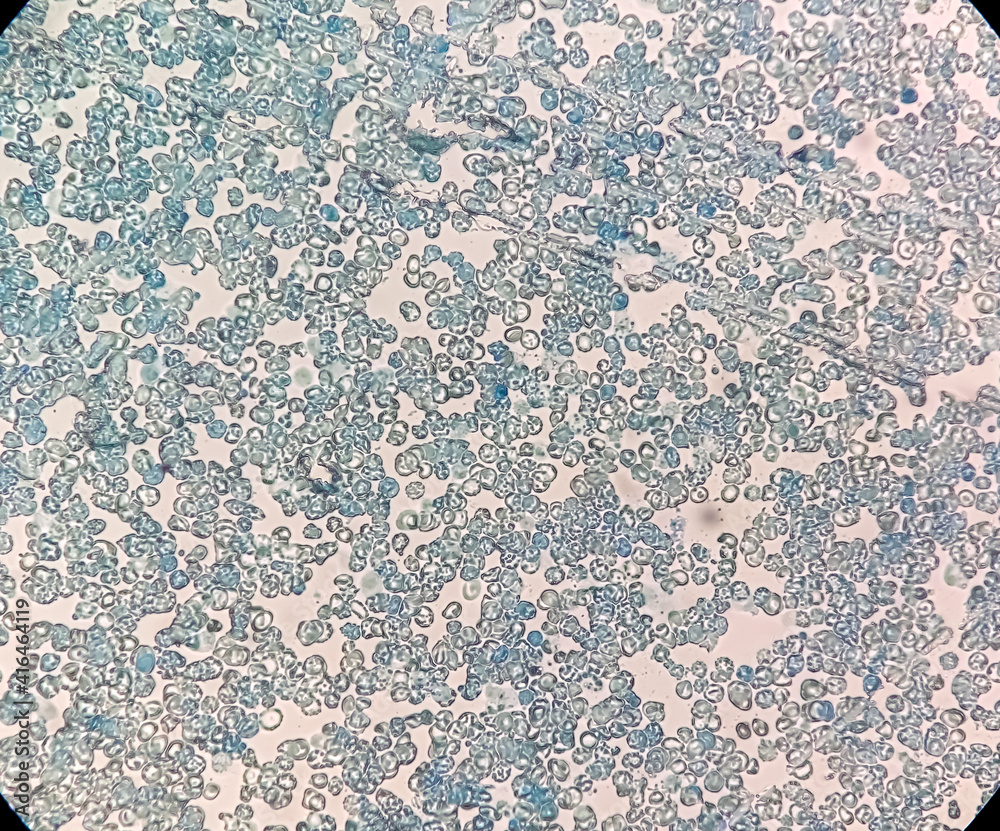 Reticulocyte count from blood smear (methylene blue staining ...