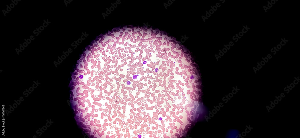 Microscopic view of hematology slide. RBC. WBC. closeup. Stained slide ...