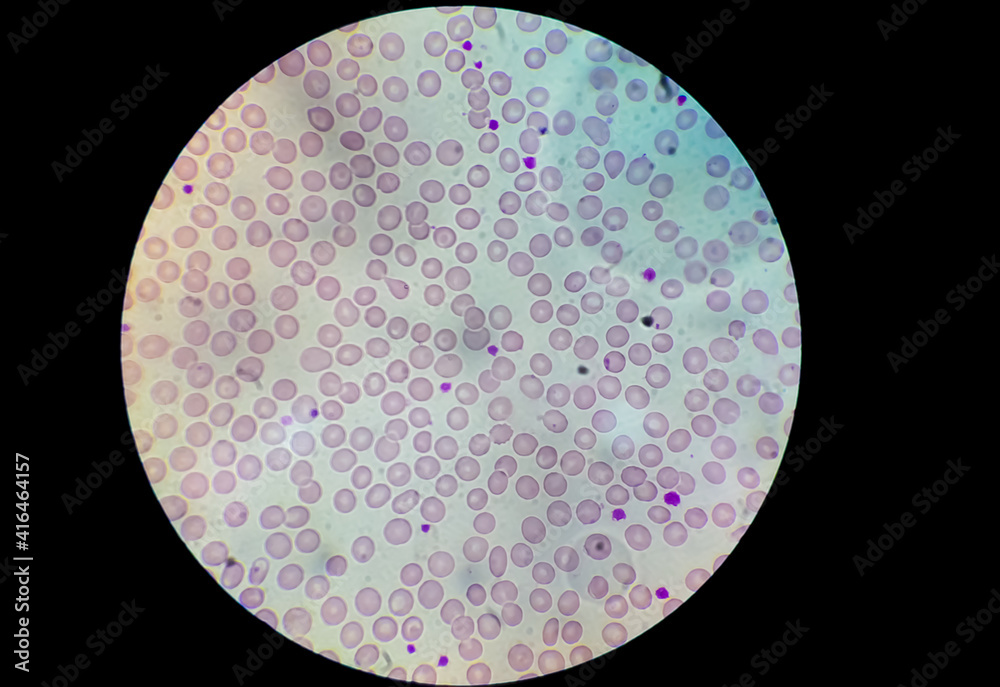 Microscopic view of hematology slide. RBC. WBC. closeup. Stained slide ...