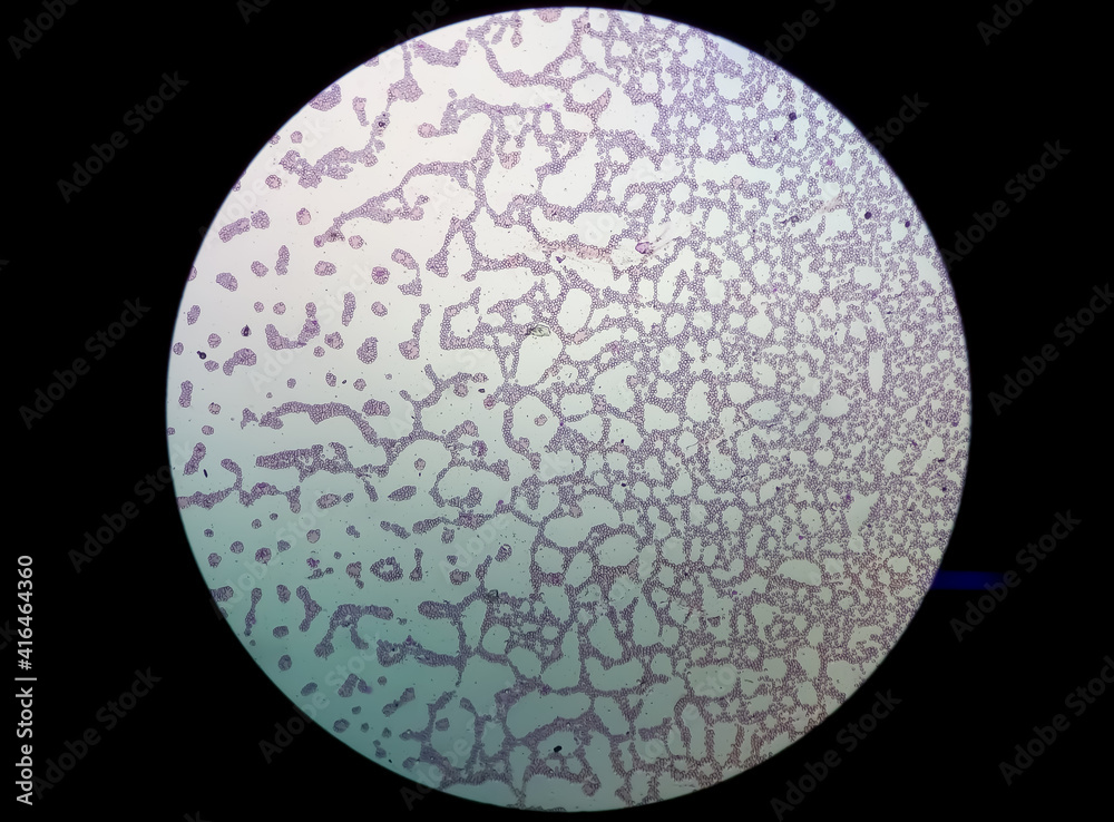 Microscopic view of hematology slide. RBC. WBC. closeup. Stained slide ...