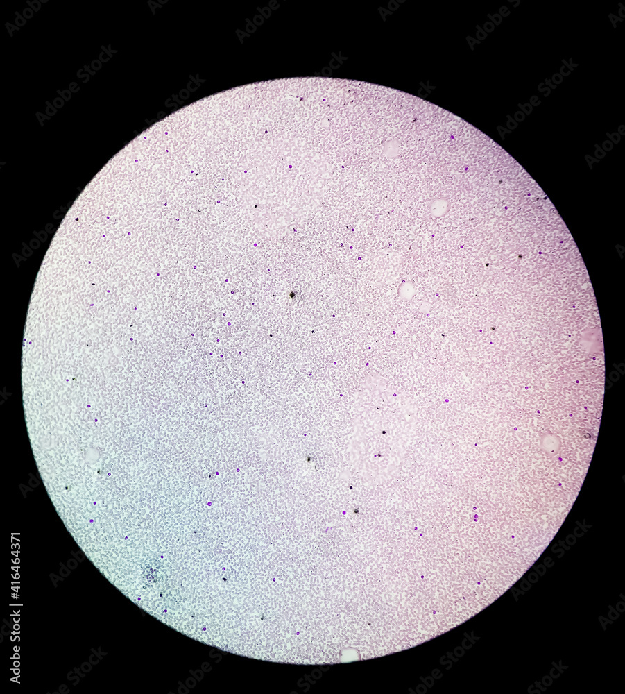 Microscopic view of hematology slide. RBC. WBC. closeup. Stained slide ...