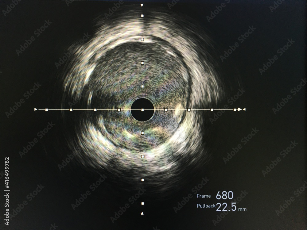 Intravascular ultrasound imaging (IVUS) at cardiac catheterization ...
