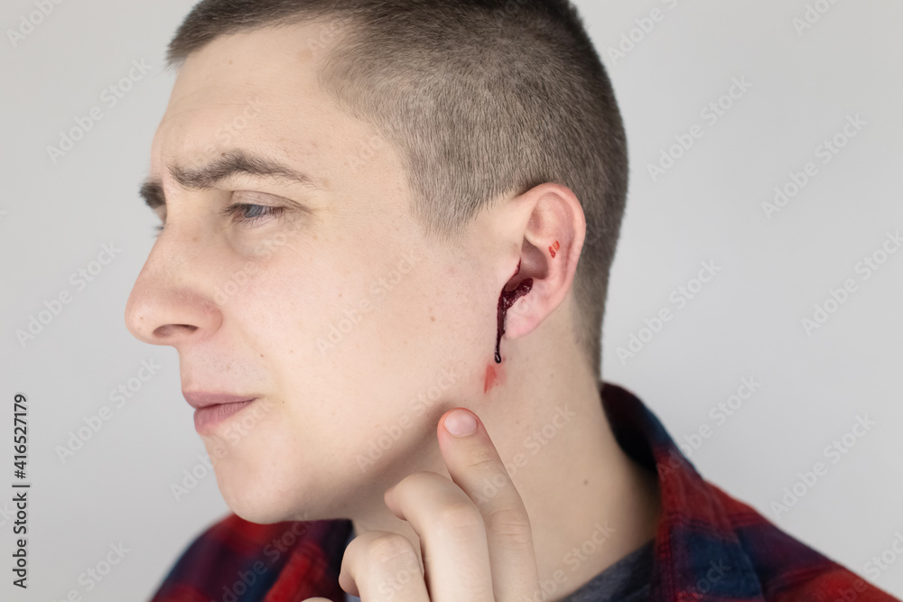 A man whose ear is bleeding. Vascular rupture, damage to the tympanic ...