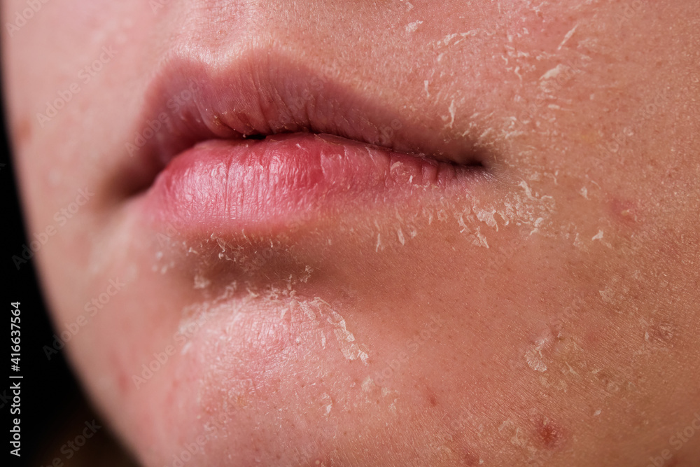 flaky skin of a girl after cosmetic procedures Stock Photo | Adobe Stock