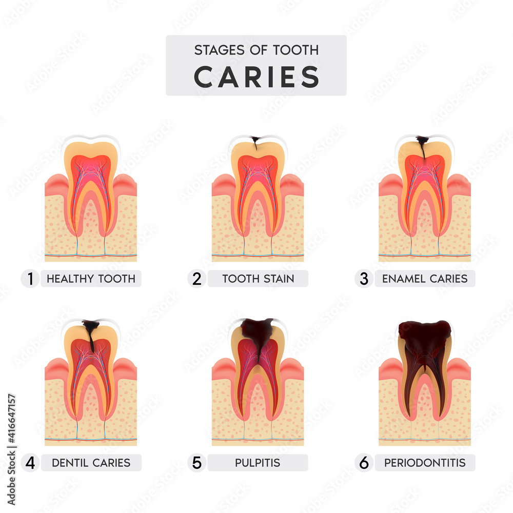 Dental Caries Progression