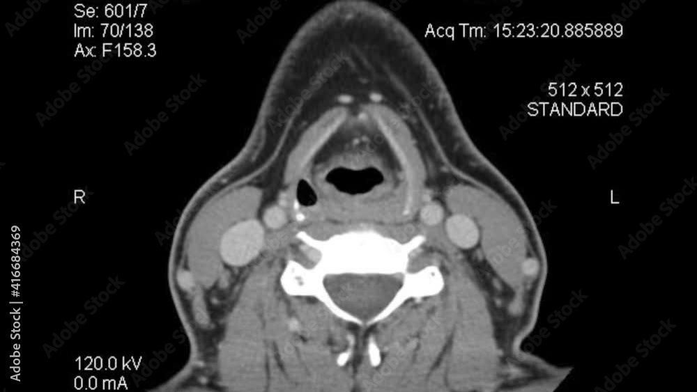 Axial Computed Tomography: CT scan layers through head into chest vídeo ...