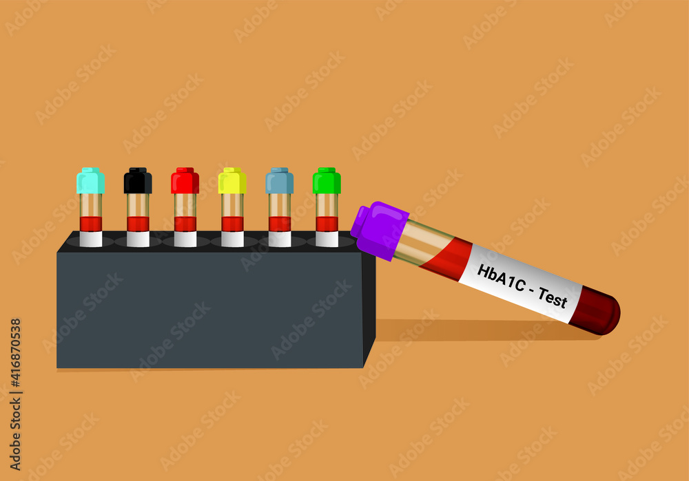 Blood sample for HbA1c (Hemoglobin A1c). Diabetic treatment monitoring ...