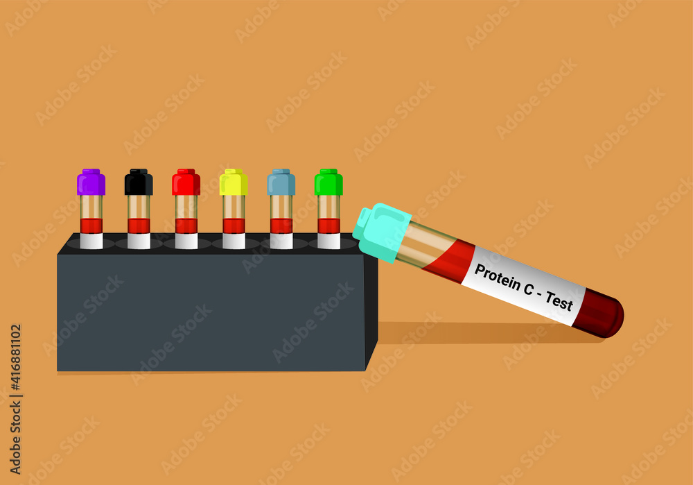 Blood sample for Protein C test. Diagnosis of coagulation disorder ...