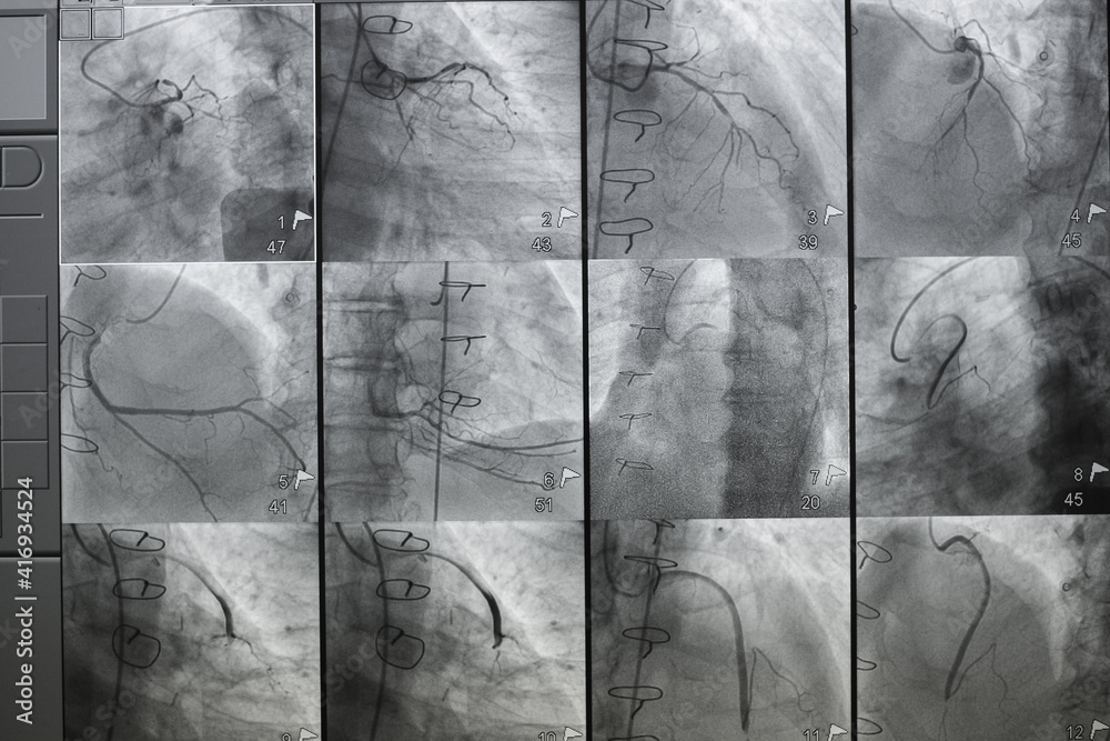 Coronary angiography , left and right coronary angiography Stock Photo ...
