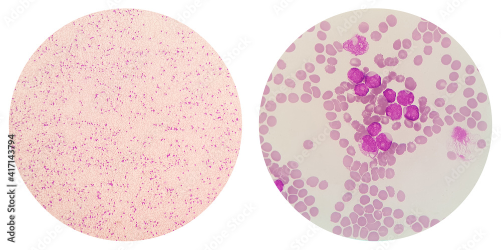 Leukemia Under Microscope