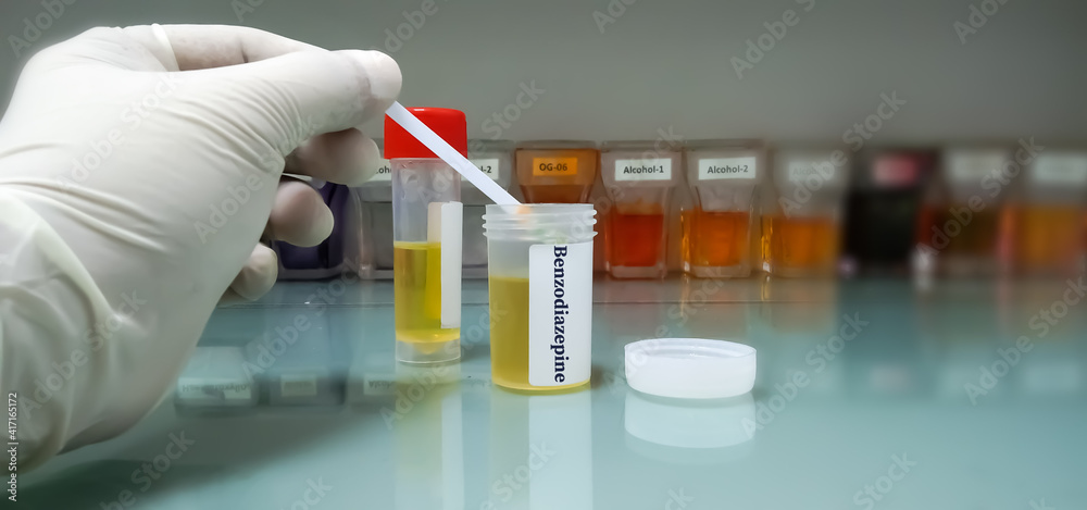 Medical laboratory container with urine sample rests on drugs test ...