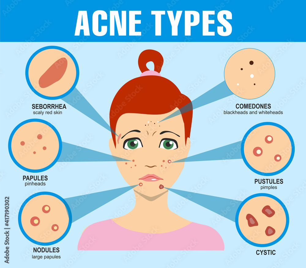 Acne types, skin pimples blackheads and face comedones. Infographics of ...