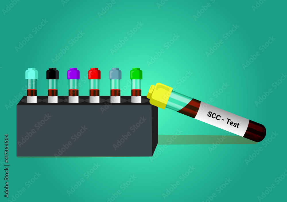 Blood sample for SCC (Squamous cell carcinoma) test, skin cancer. A ...