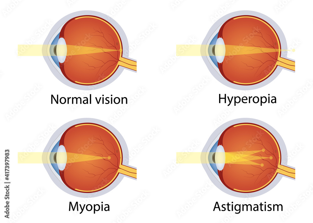 Vision disorders. Concept of eyes defect. Normal vision, hyperopia ...