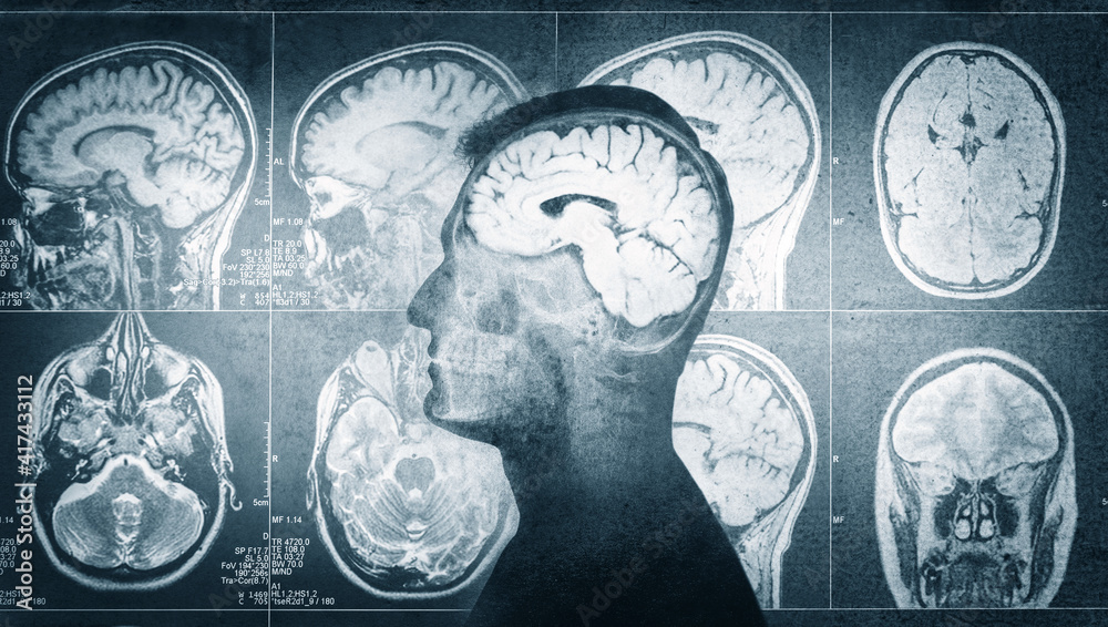 Human head on CT scan with brain background. Medical, science and ...