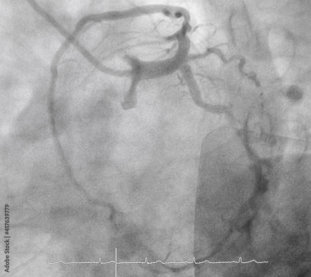 Coronary angiogram , medical x-ray for heart disease. Coronary artery ...