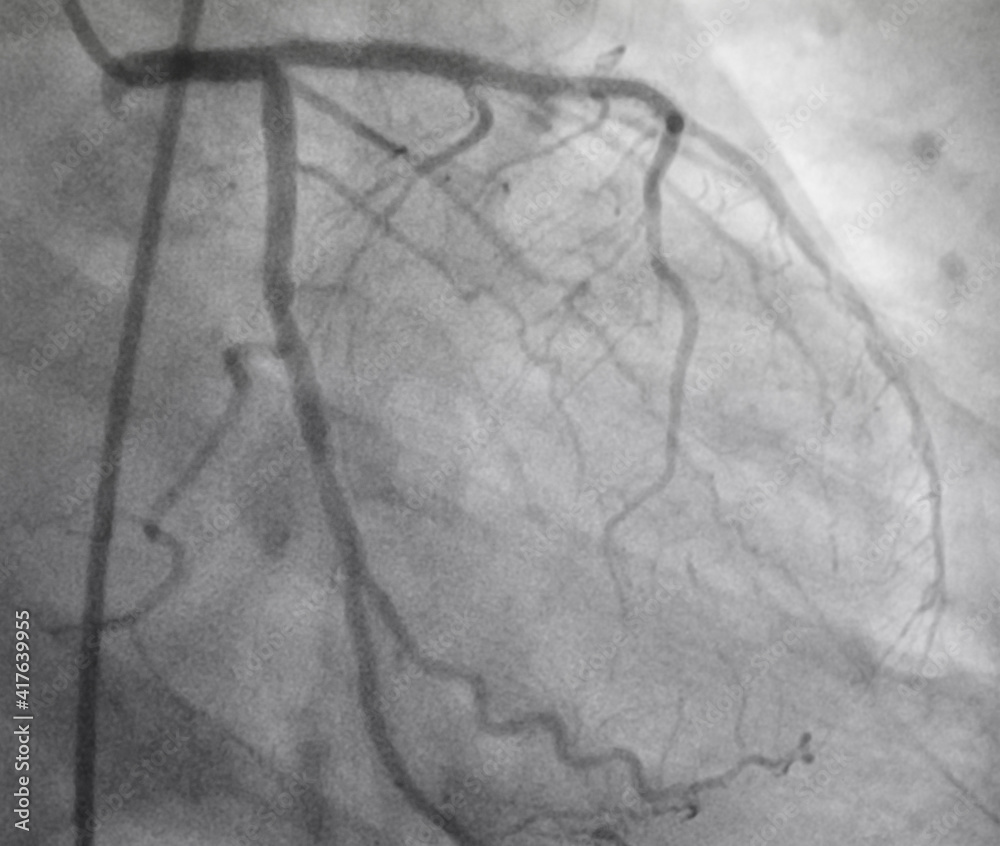 Coronary angiogram , medical x-ray for heart disease. Coronary artery ...