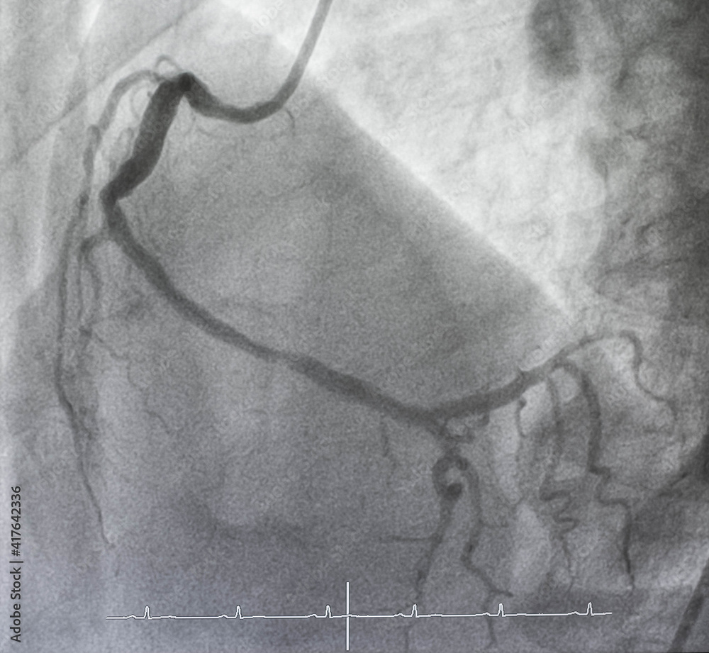 Coronary angiogram , medical x-ray for heart disease. Coronary artery ...