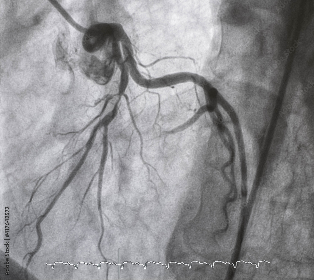 Coronary angiogram , medical x-ray for heart disease. Coronary artery ...