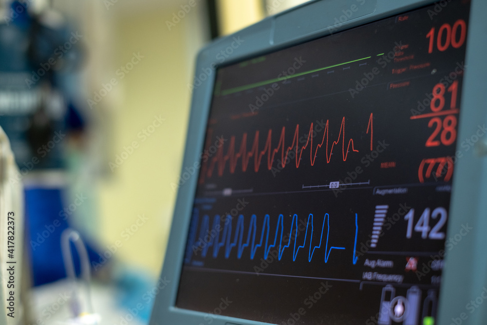 EKG monitor in intra aortic balloon pump machine. Medical equipment ...