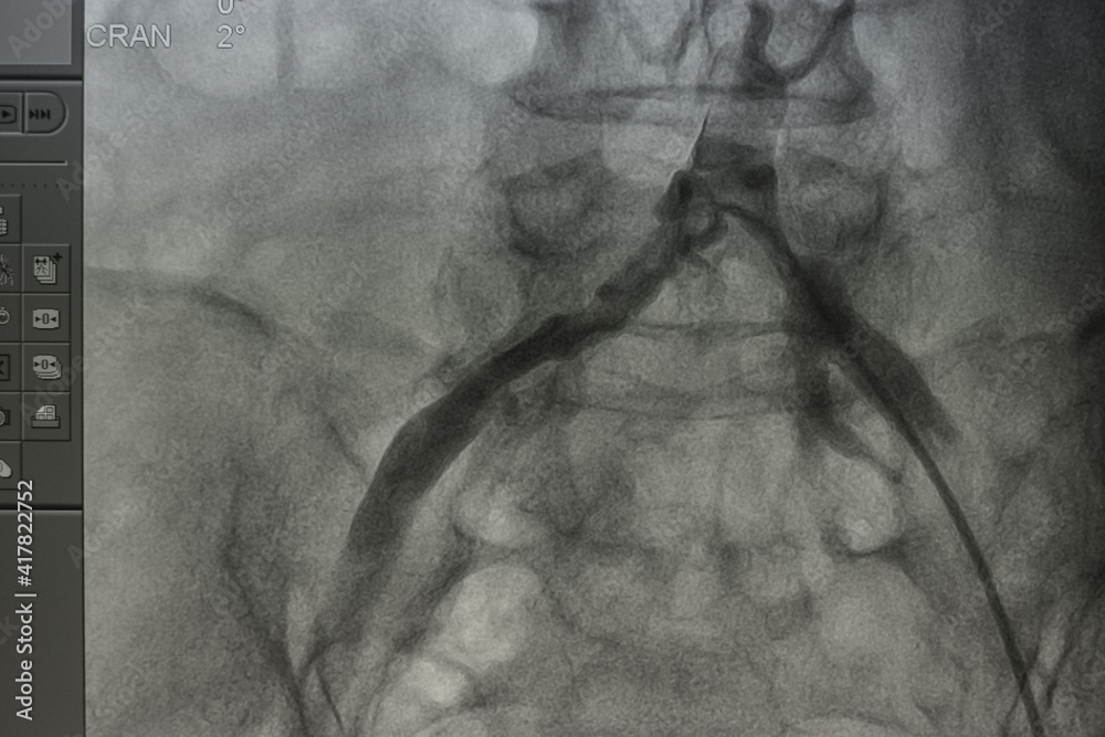 Coronary angiogram , medical x-ray for heart disease. Coronary artery ...