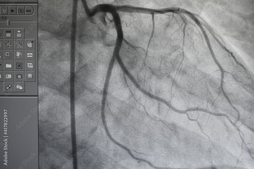 Coronary angiogram , medical x-ray for heart disease. Coronary artery ...