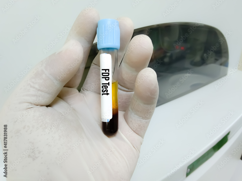 Foto de D-Dimer,FDP test. Corona patient monitoring test in ICU. Doctor ...
