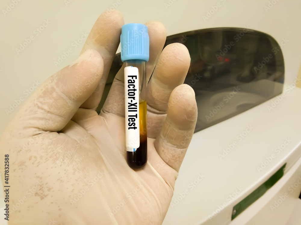 Blood sample for Factor VII or anti-hemophilic factor, diagnosis of ...