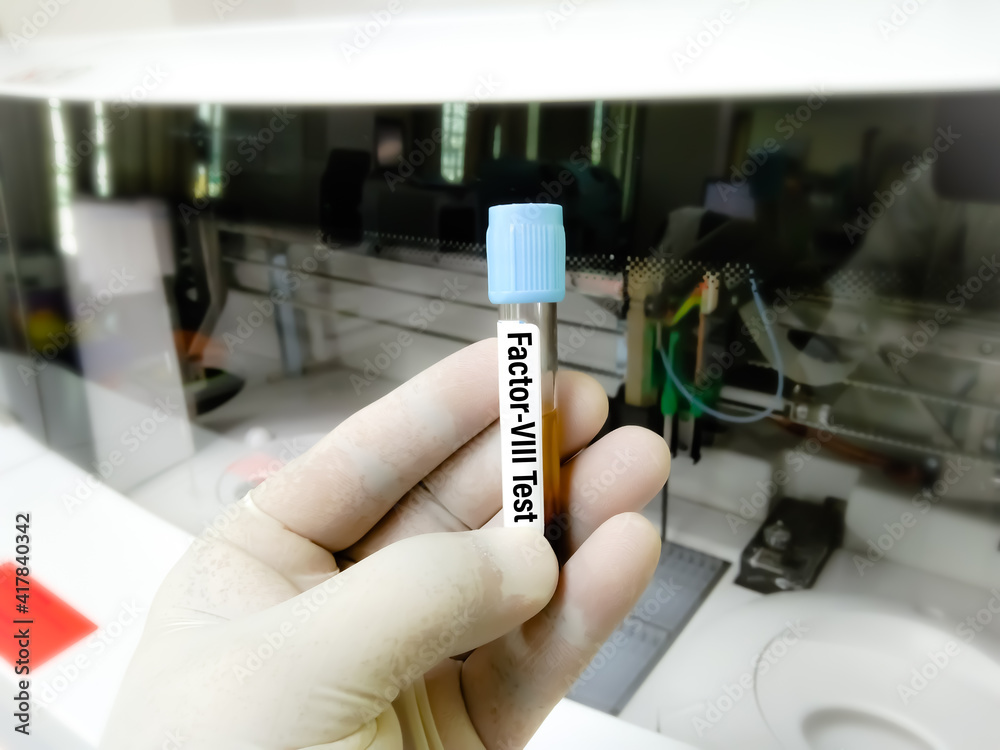 Blood sample for Factor VII or anti-hemophilic factor, diagnosis of ...