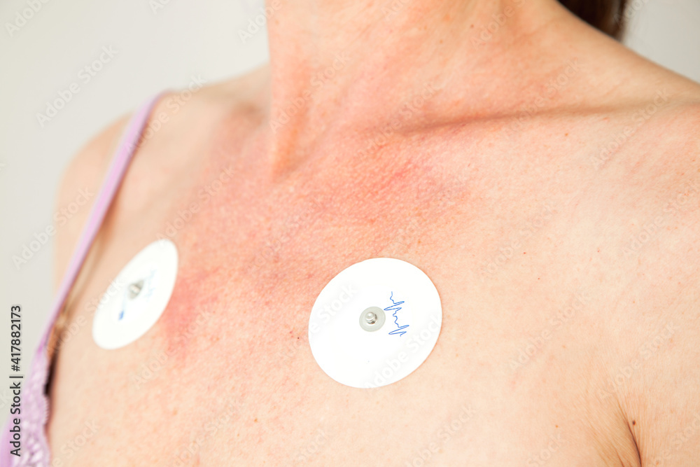 Pulse trace electrodes on a patient. Forgotten ECG electrodes on a ...