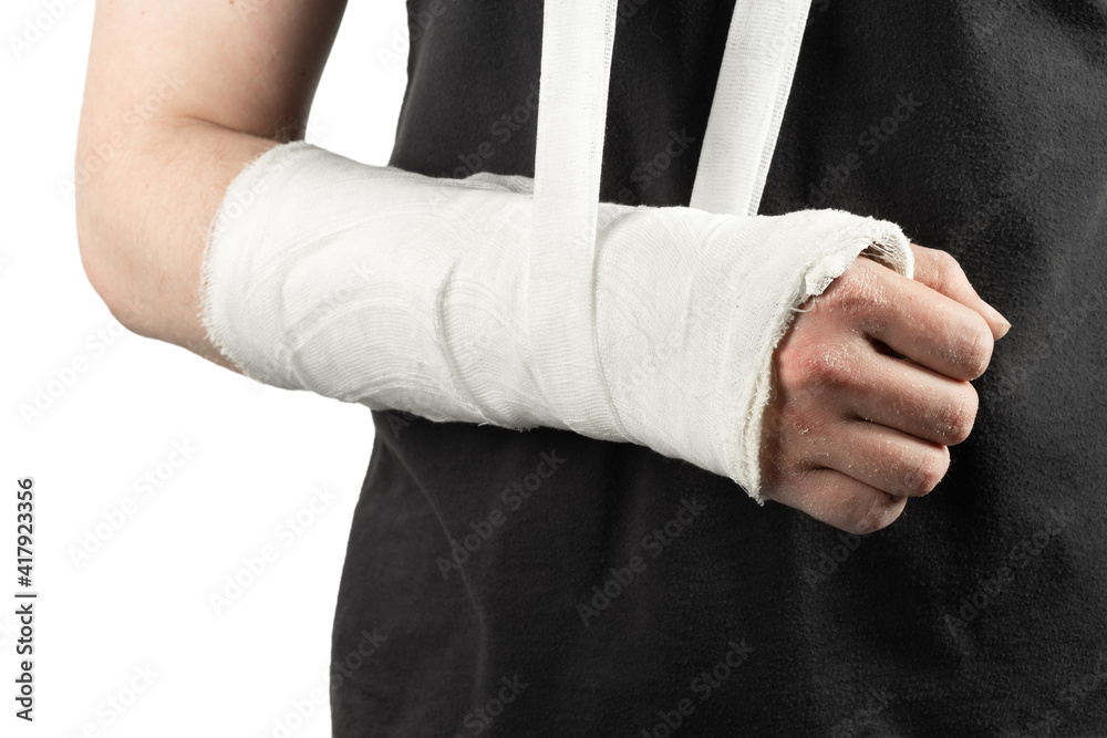 Broken arm Stock Photo | Adobe Stock