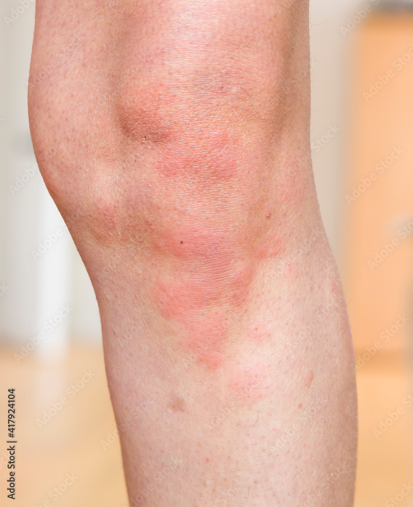 Hives rash (urticaria), skin condition, skin allergy on body, UK Stock ...