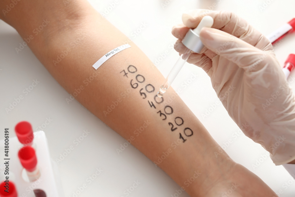 Foto de Young woman undergoing procedure of allergen skin tests in ...