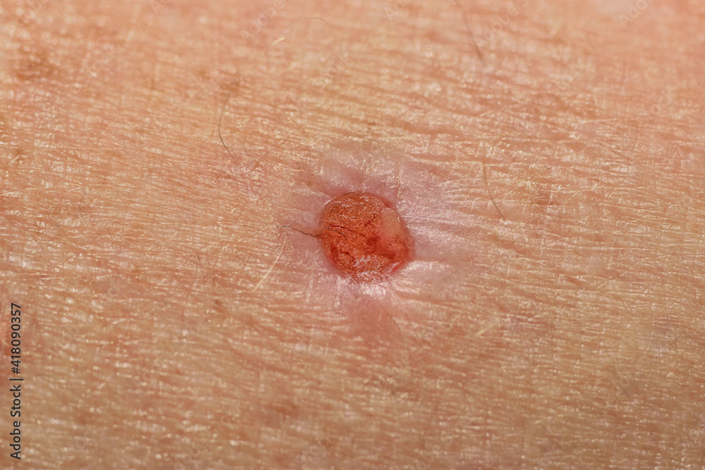 Hautwunde nach Gewebe Biopsie Stock Photo | Adobe Stock