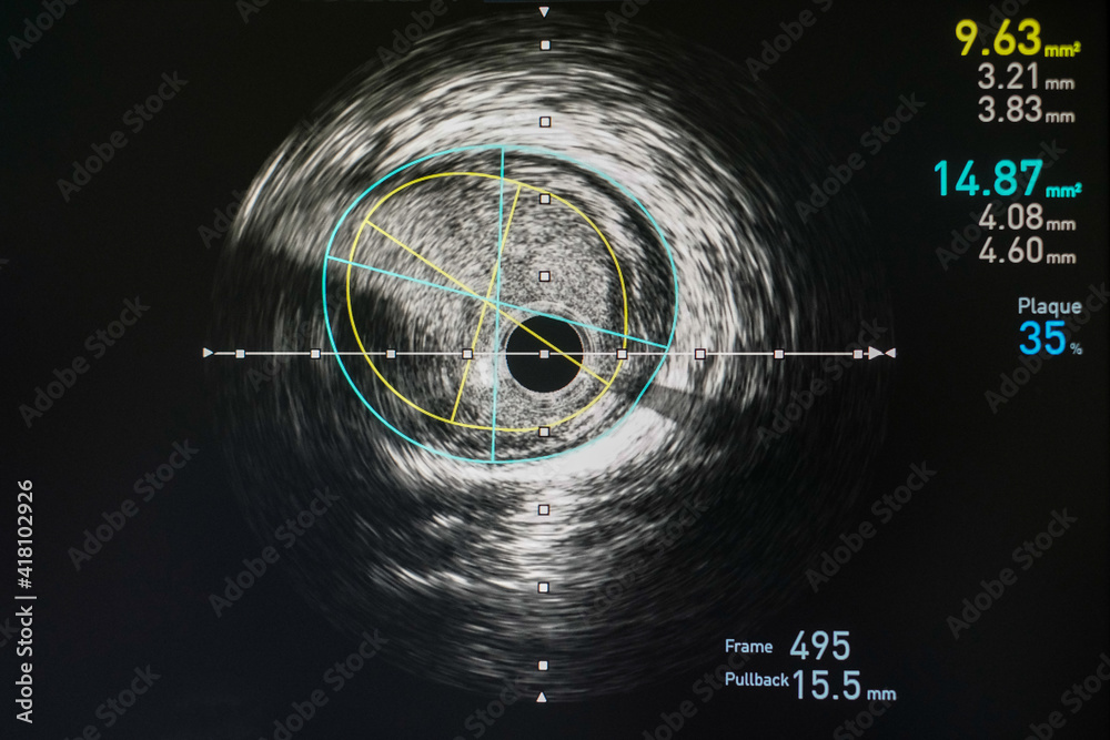 Intravascular ultrasound imaging (IVUS) at cardiac catheterization ...